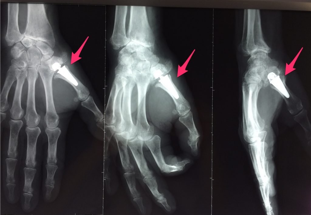 Arthrose trapézo-métacarpienne du pouce (Rhizarthrose) | Chirurgie ...