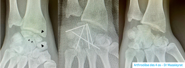 Traitement de l'arthrose du poignet | Arthropole Sud Gironde - Bordeaux ...